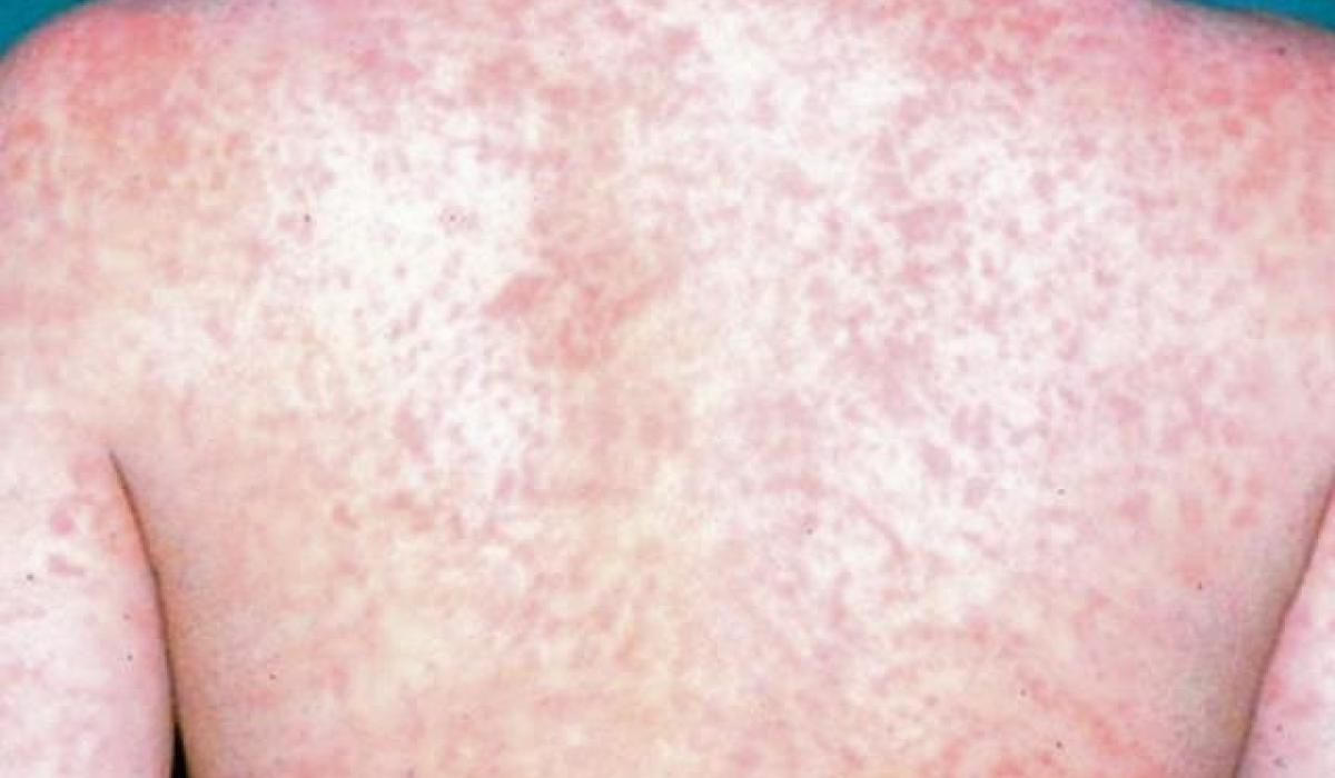 Fourth case of measles confirmed in Ireland amid HSE alert - Limerick Live