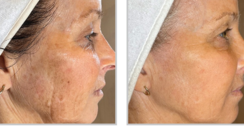 Award-winning laser skin technology favoured by Kim Kardashian comes to ...